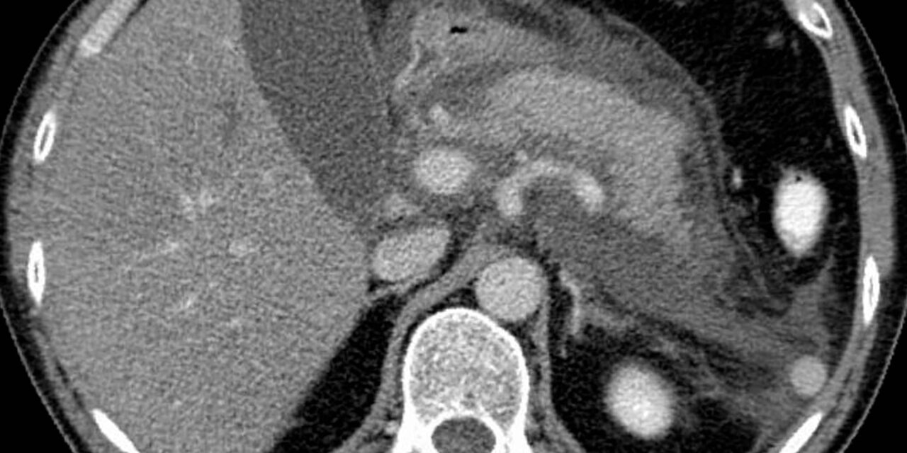 IHU Strasbourg | Pancréas : Pancréatite aiguë