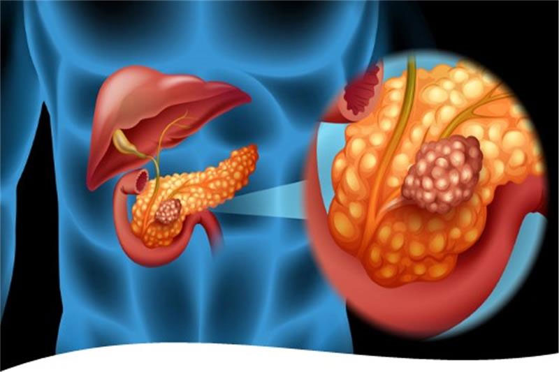 Médecine prédictive et personnalisée du cancer du pancréas I AAP ...